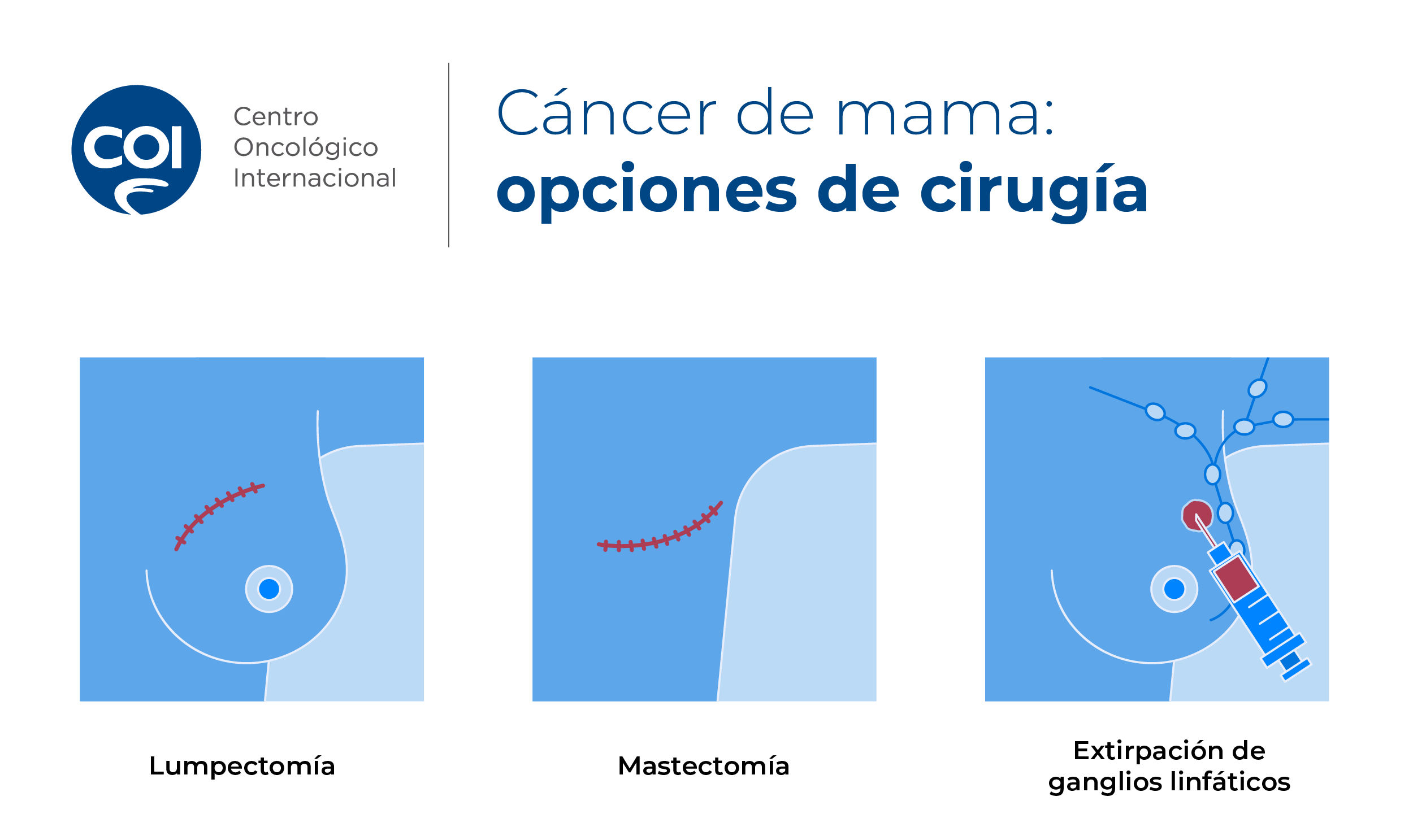 ¿Qué es la reconstrucción mamaria? Tipos, procedimiento, riesgos y ...